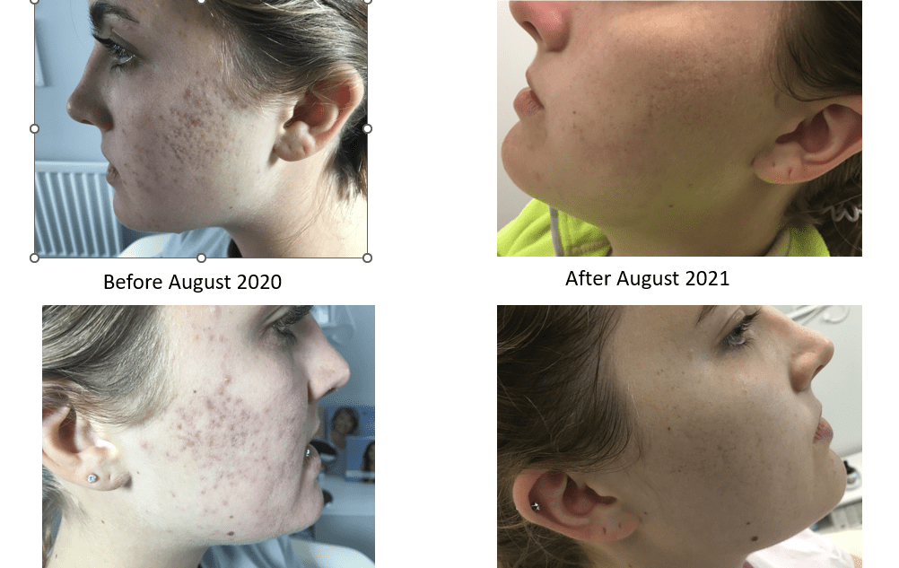 Acne Treatment Bromsgrove - NR Aesthetics & Skin