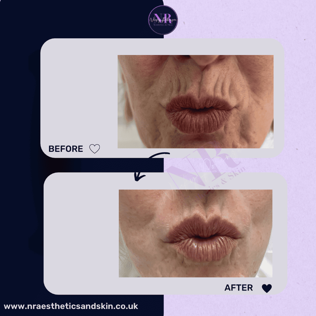 Peri Oral Mouth Lines - NR Aesthetics & Skin